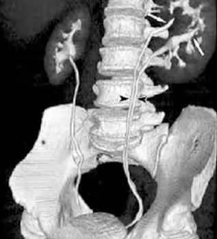 Blood in Urine (Hematuria) Causes & Care | Advanced Urology